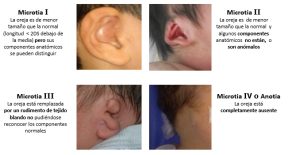 Microtia - Prevención y Vigilancia de anomalías congénitas
