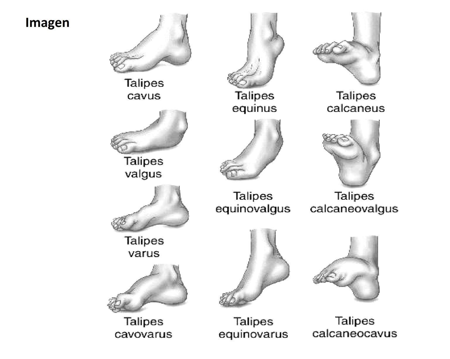 Talipes - Prevención y Vigilancia de anomalías congénitas