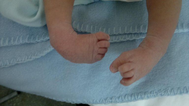 Talipes - Prevención y Vigilancia de anomalías congénitas